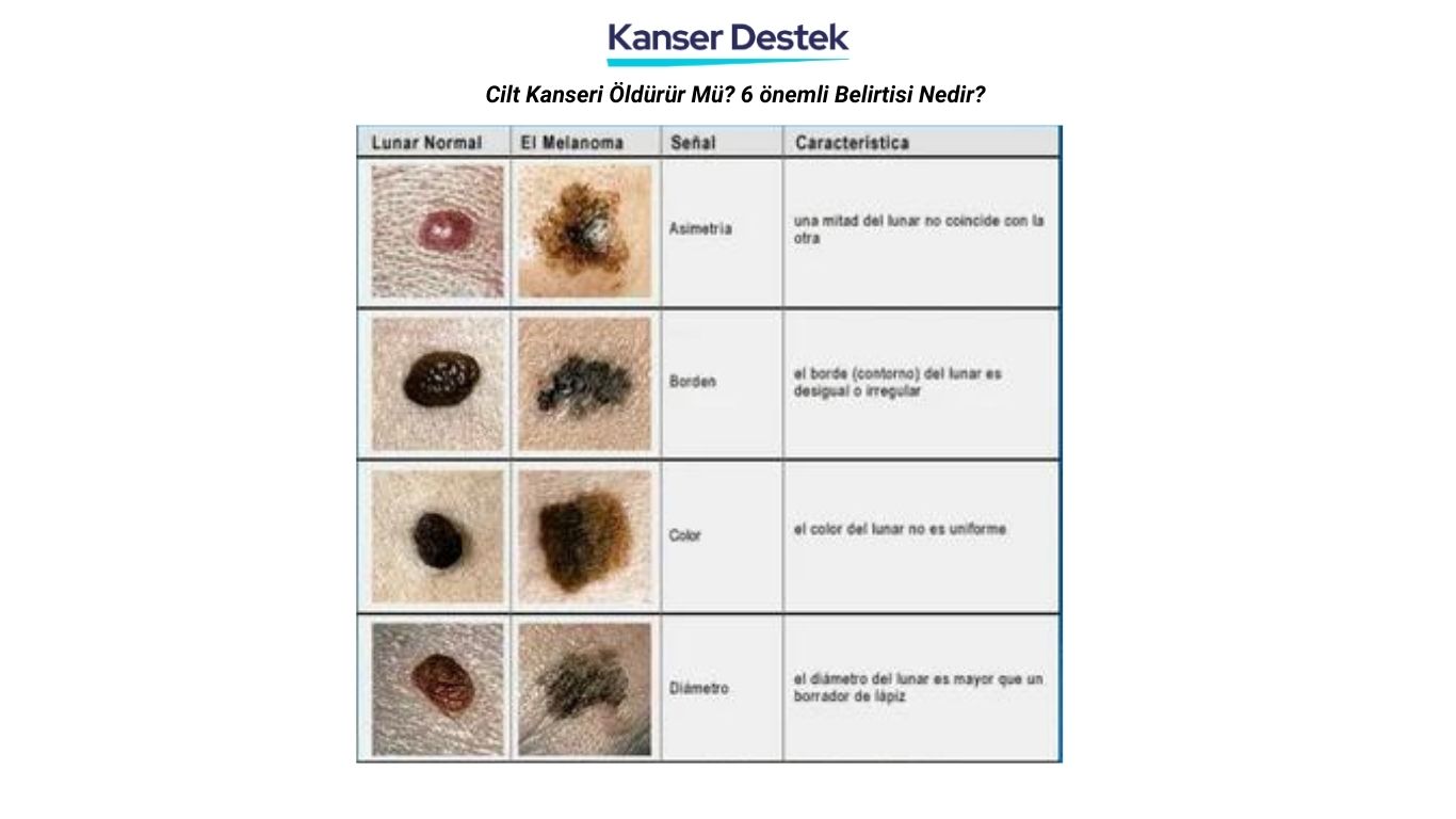 Cilt Kanseri Öldürür Mü? İşte 6 Önemli Belirtisi